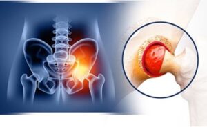 Managing Swelling 3 Months After Hip Replacement | Dr Sandeep Singh