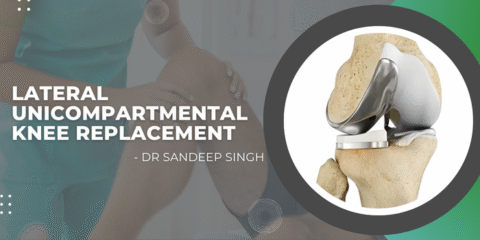 Lateral Unicompartmental Knee Replacement