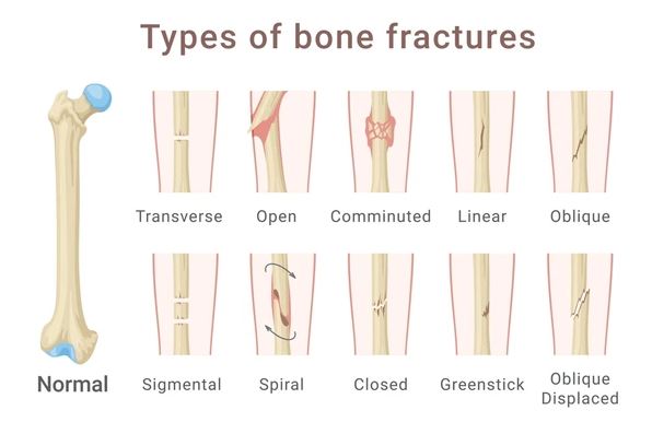 What is a Fracture and Its Types | Dr. Sandeep Singh